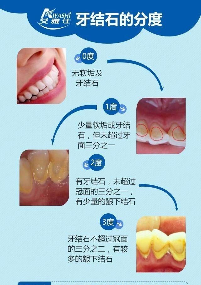 漱口水到底有什么用口腔护理液和漱口水有什么区别 闪电鸟